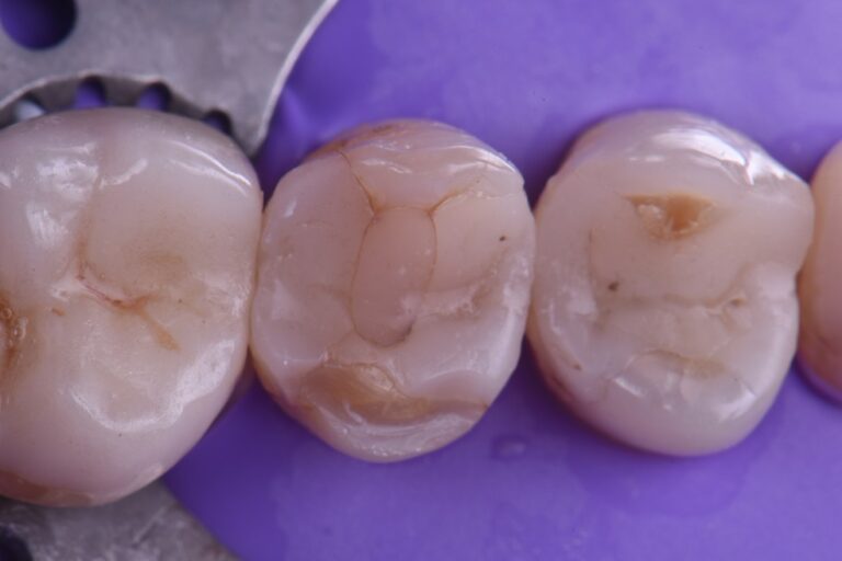 Dental Overlay Minimal Intervention Design