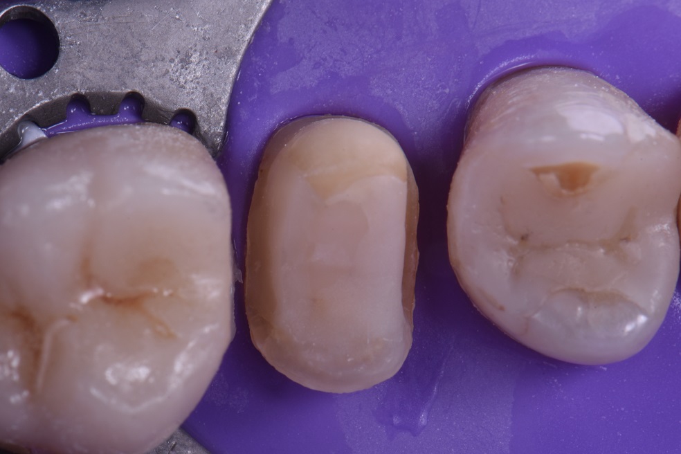 Dental Overlay Minimal Intervention Design