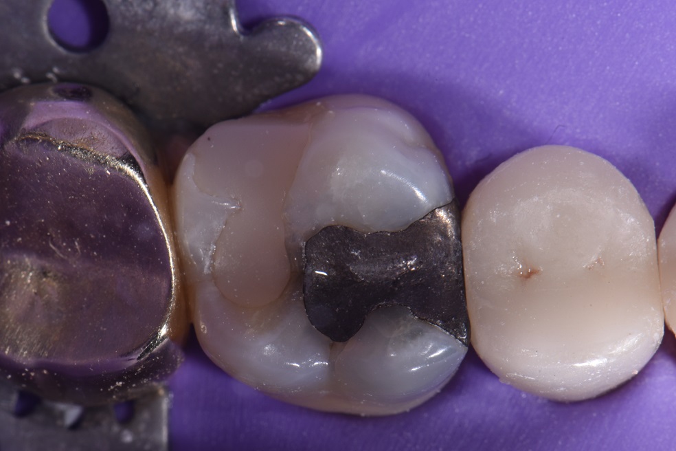 Removing Amalgam stain and damage Removing Amalgam stain and damage