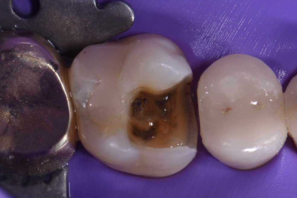 Removing Amalgam stain and damage Removing Amalgam stain and damage