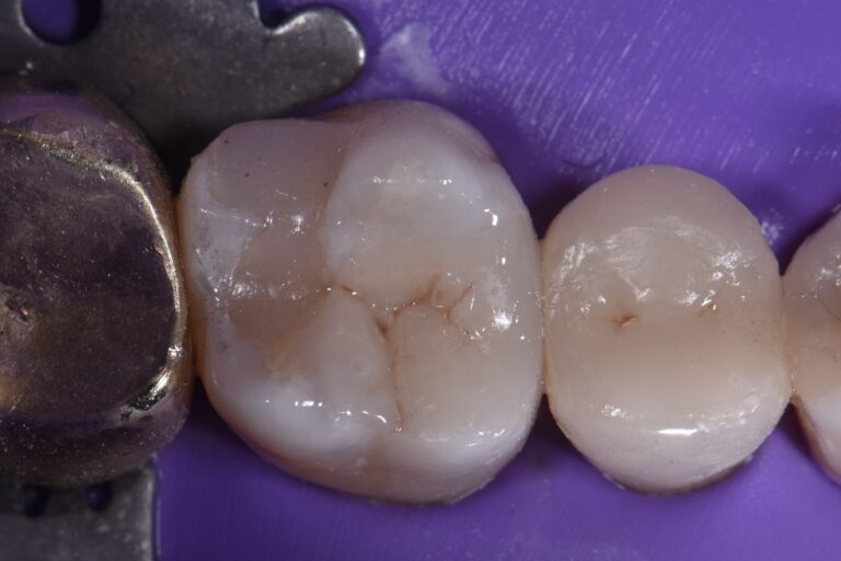 Removing Amalgam stain and damage Removing Amalgam stain and damage