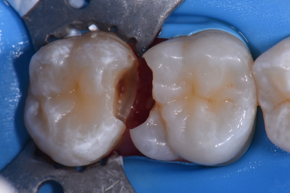 Deep proximal caries restored with Voco Grandio SO Deep proximal caries ...