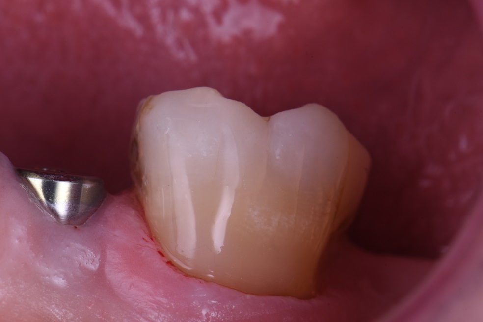 Composite mimicking natural enamel reflection Composite mimicking ...