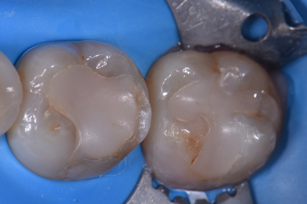 Large restorations with Kuraray Majesty ES-2 Universal Large ...