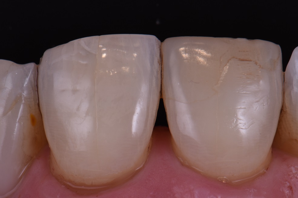 Biomaterial Mimicking Dentin Physical Properties Biomaterial Mimicking ...