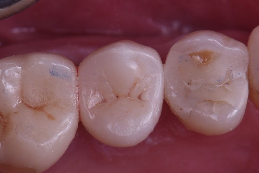 Dental Overlay Minimal Intervention Design