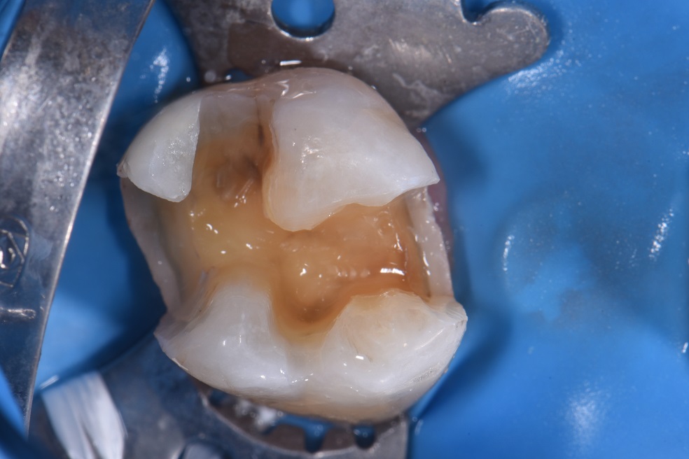 Molar Reconstruction in Direct Composite Auckland Molar Reconstruction ...