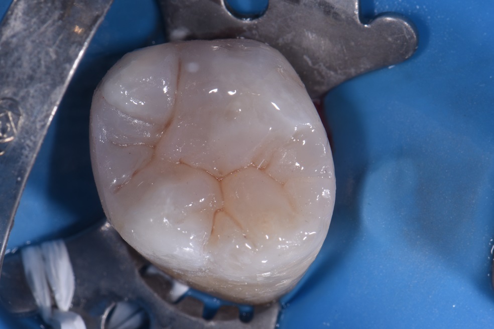 Molar Reconstruction in Direct Composite Auckland Molar Reconstruction ...