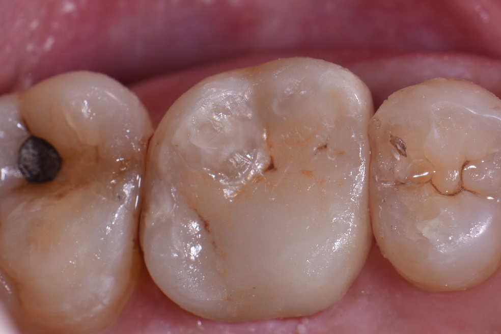 Bonded Dental Onlays and Overlays Auckland Dental Onlays and Overlays ...