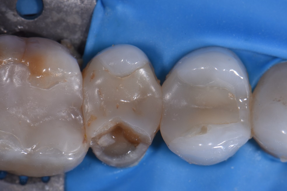 Premolar Composite Onlays and Overlays Premolar Composite Onlays and ...