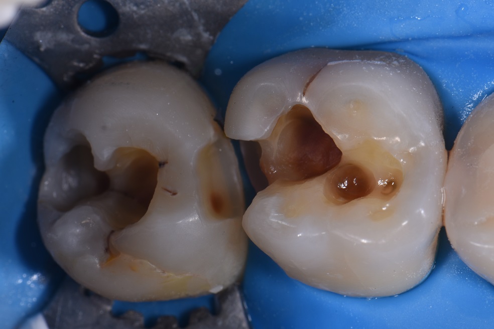 Complex Composite Reconstruction of Molars Complex Composite ...