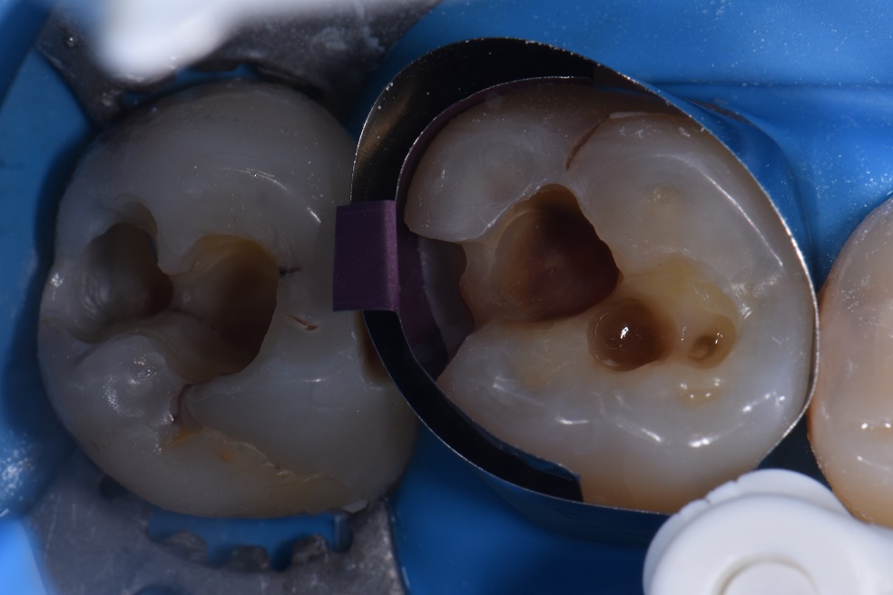 Complex Composite Reconstruction of Molars Complex Composite ...