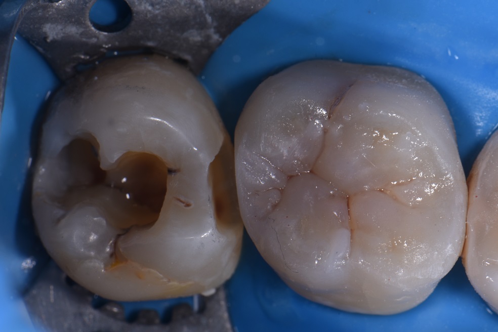 Complex Composite Reconstruction of Molars Complex Composite ...