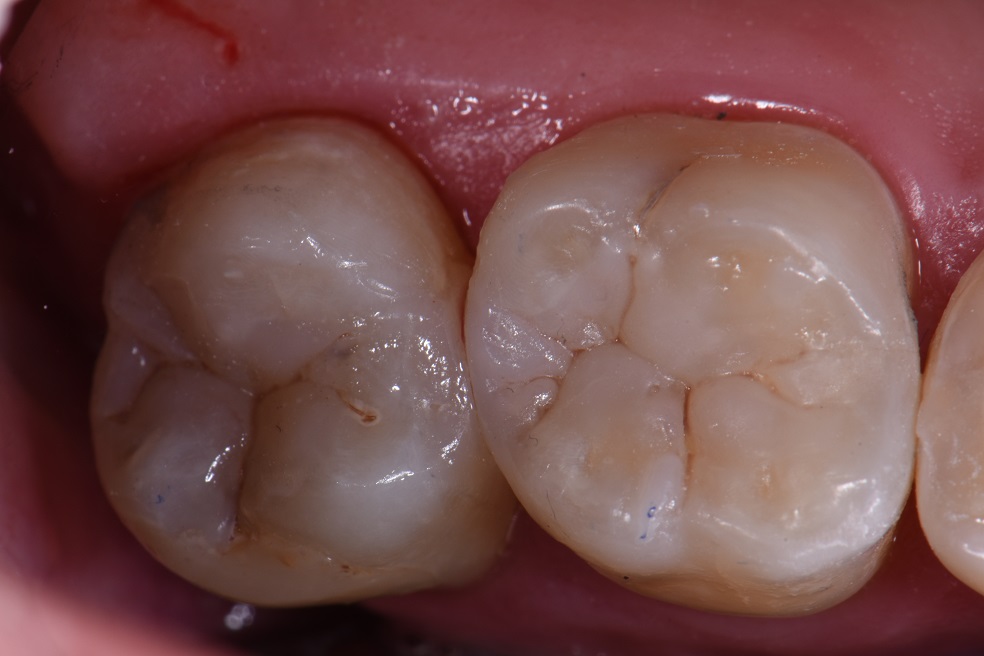 Complex Composite Reconstruction of Molars Complex Composite ...