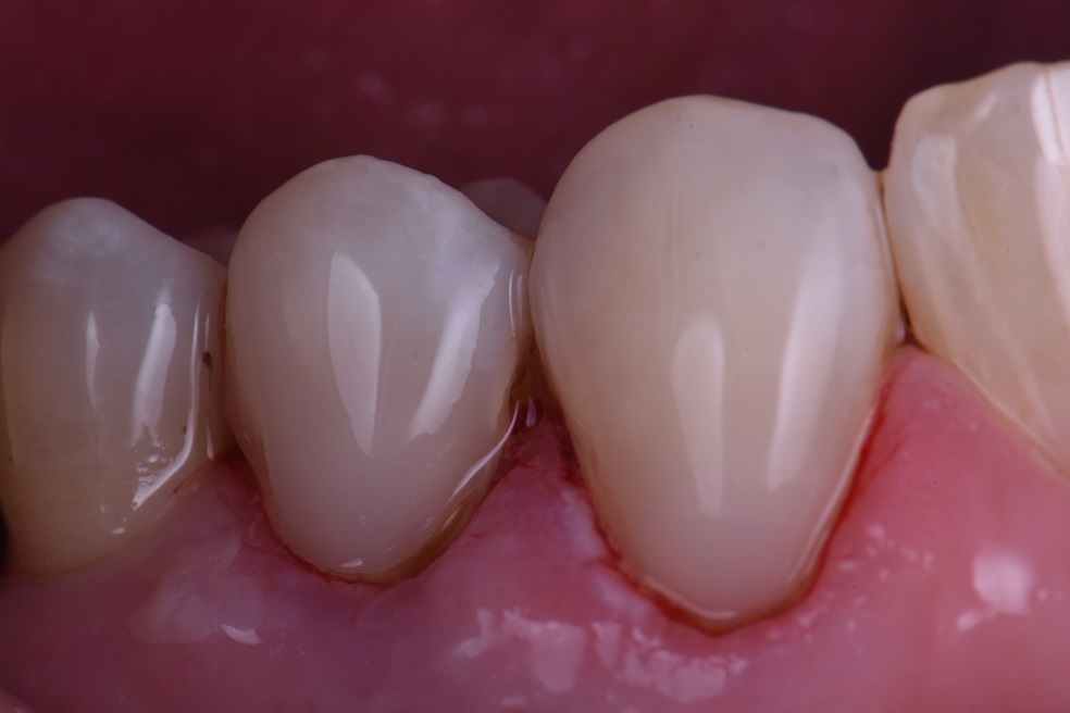 GC Essentia U chameleon effect Class V restorations