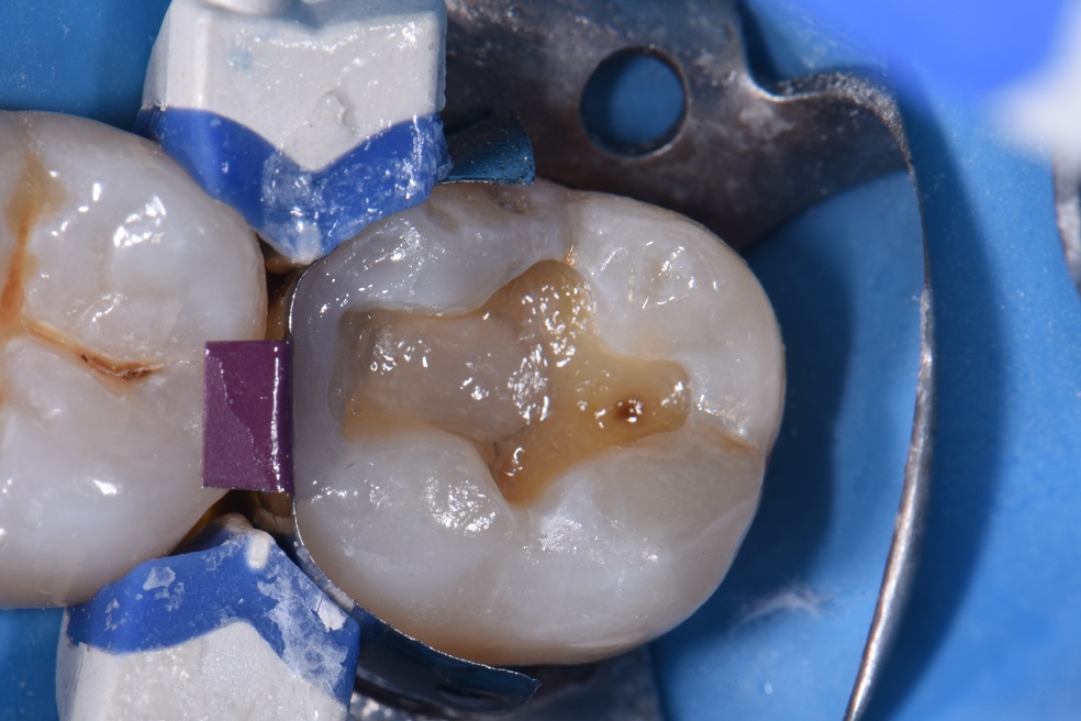 Partial Restoration Replacements with Composite Resin Partial ...