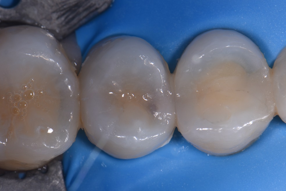 Simple Slot Restorations Dental Simple Slot Restorations Dental