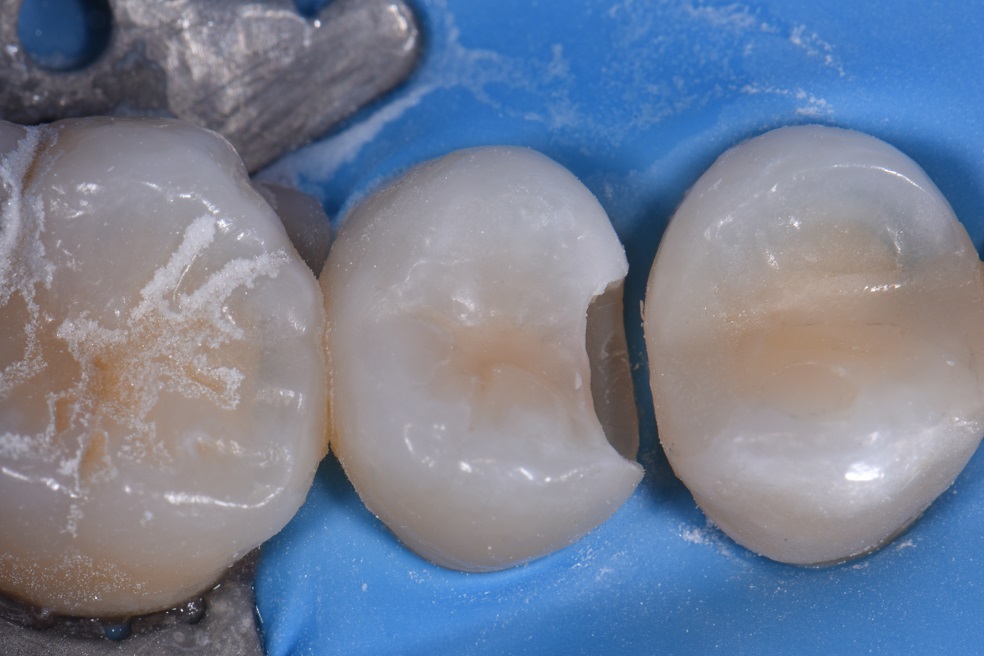 Simple Slot Restorations Dental Simple Slot Restorations Dental