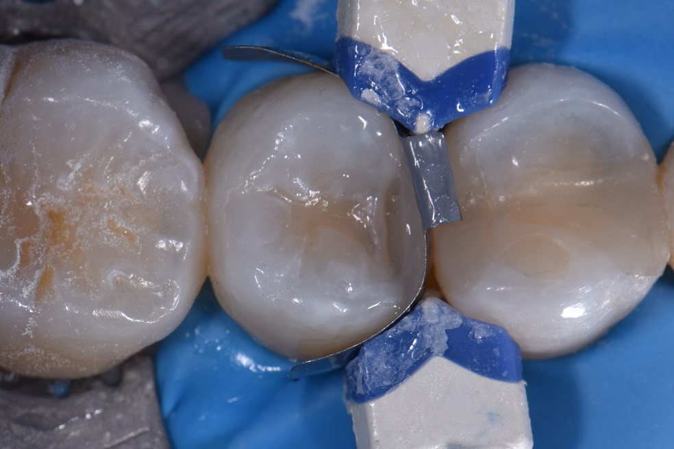 Simple Slot Restorations Dental Simple Slot Restorations Dental