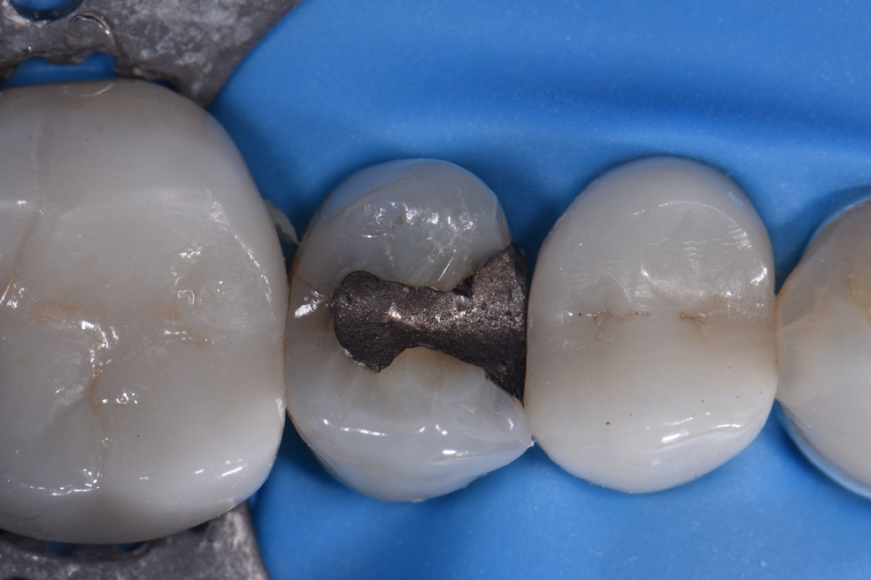 Amalgam Replacement Due to Cracked Teeth Amalgam Replacement Due to ...