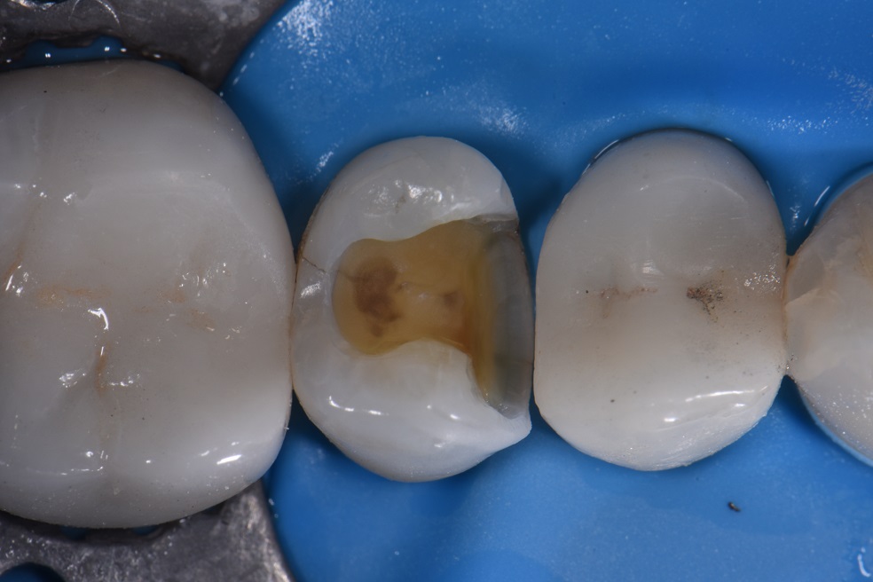 Amalgam Replacement Due to Cracked Teeth Amalgam Replacement Due to ...
