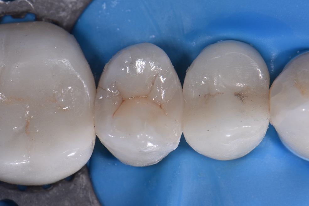 Amalgam Replacement Due to Cracked Teeth Amalgam Replacement Due to ...