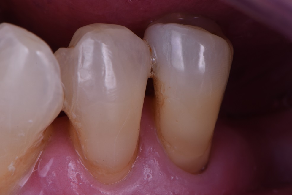 Class V Resin Additions Class V Resin Additions