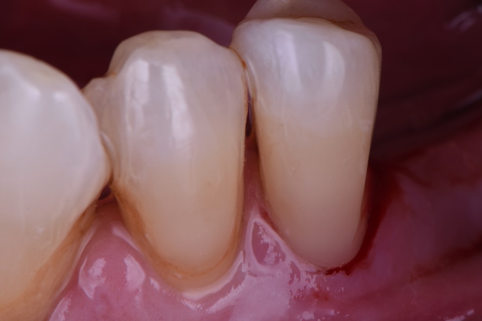Class V Resin Additions Class V Resin Additions