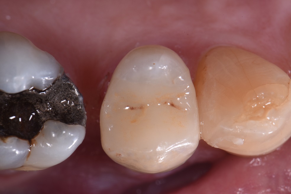 Auckland Dental Overlays Onlays Auckland Dental Overlays Onlays