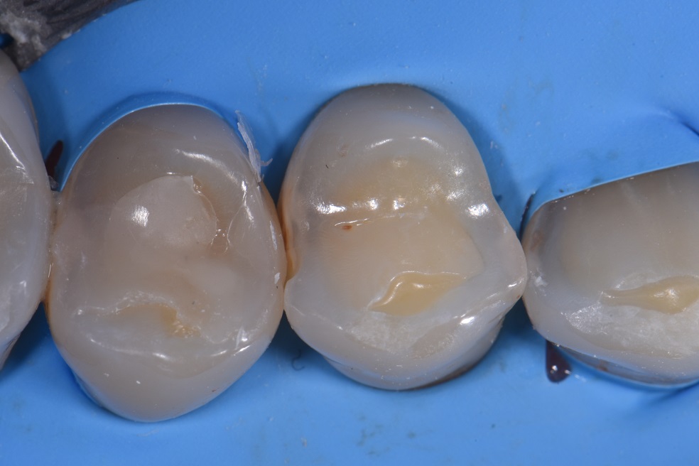 Slot Prep and Partial Restorative Therapy