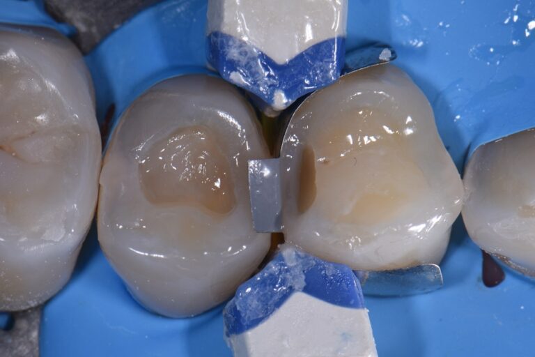 Slot Prep and Partial Restorative Therapy