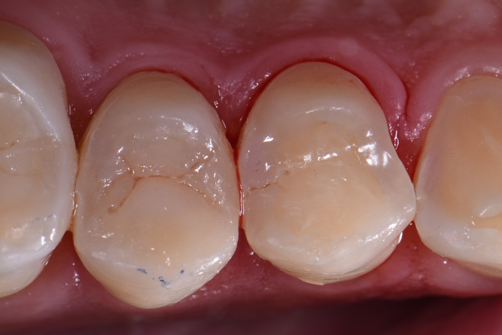 Slot Prep and Partial Restorative Therapy
