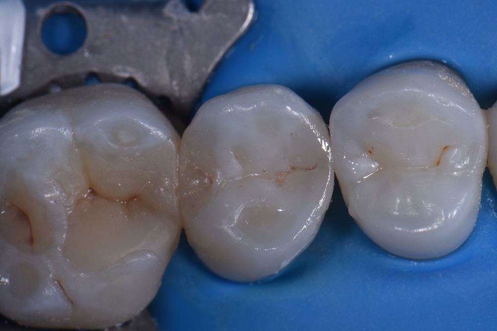 Simple Slot Prep Restoration Complexities Simple Slot Prep Restoration ...