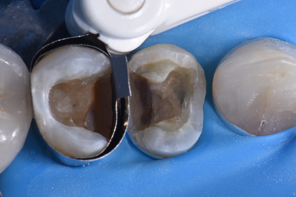 Matrix in a Matrix featuring Garrison and Ultradent