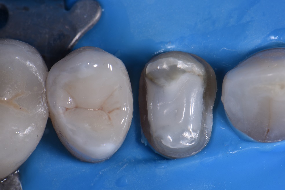 Matrix in a Matrix featuring Garrison and Ultradent