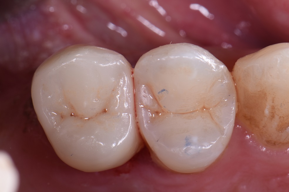 Supercomposite and Lithium Disilicate Case Supercomposite and Lithium ...