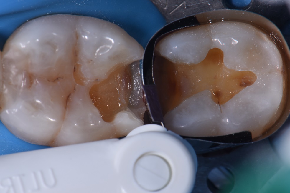 Composite Restorations that Look Natural Composite Restorations that ...
