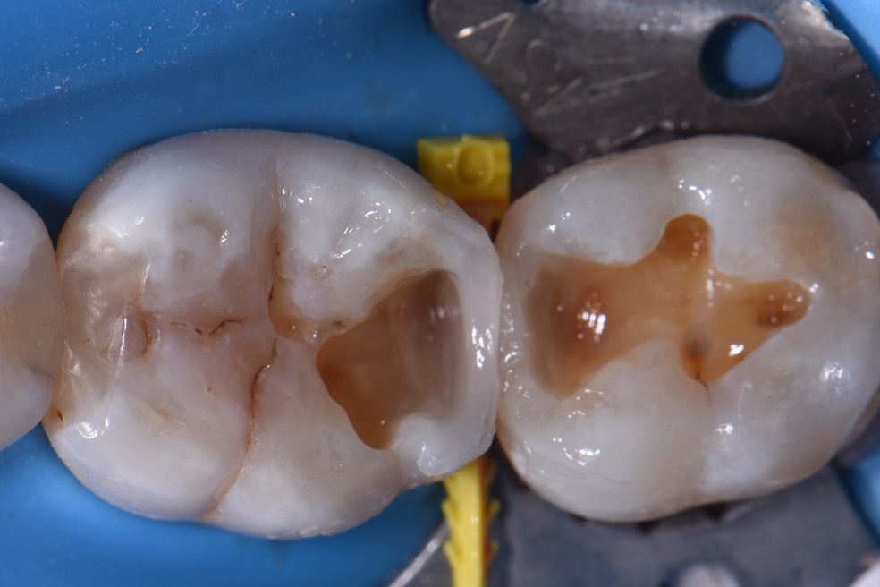 Composite Restorations that Look Natural Composite Restorations that ...