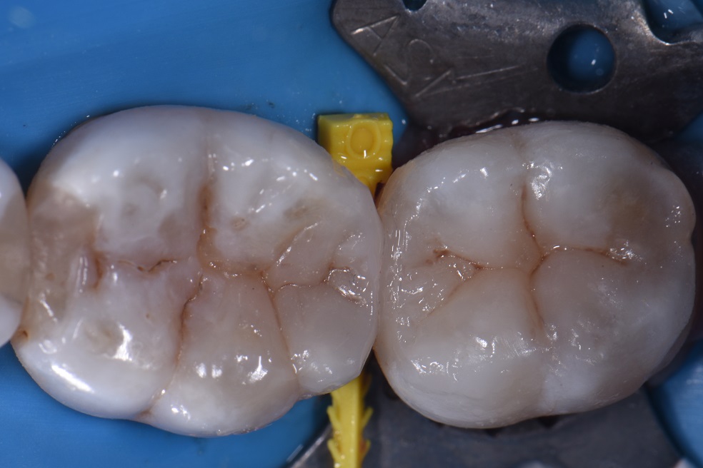 Composite Restorations that Look Natural Composite Restorations that ...