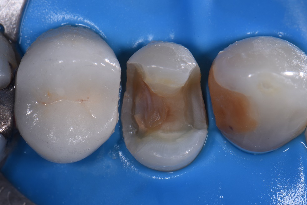 Bicuspid Restorations Bicuspid Restorations