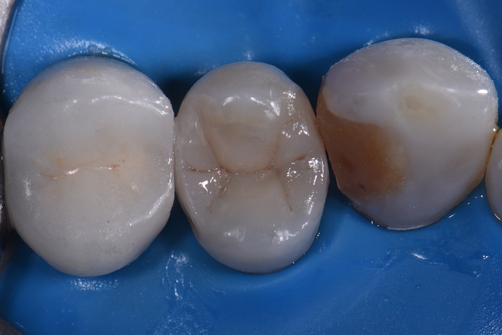 Bicuspid Restorations Bicuspid Restorations