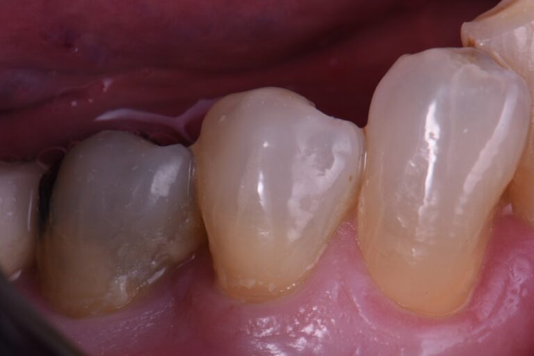 Desensitizing Root Surfaces Desensitizing Root Surfaces