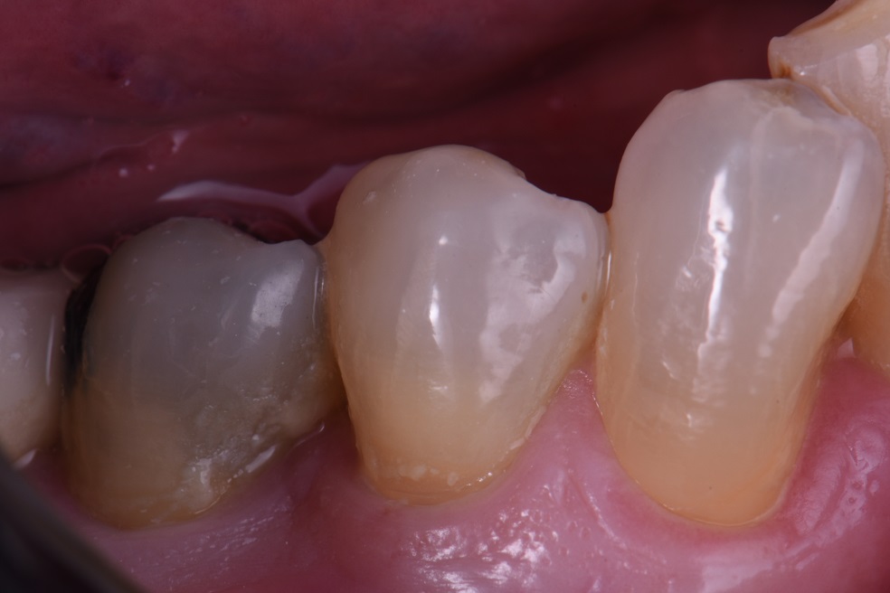 Desensitizing Root Surfaces Desensitizing Root Surfaces
