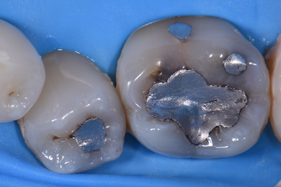 Celebrating Voco Grandio SO 10 year Biophilic Dentistry