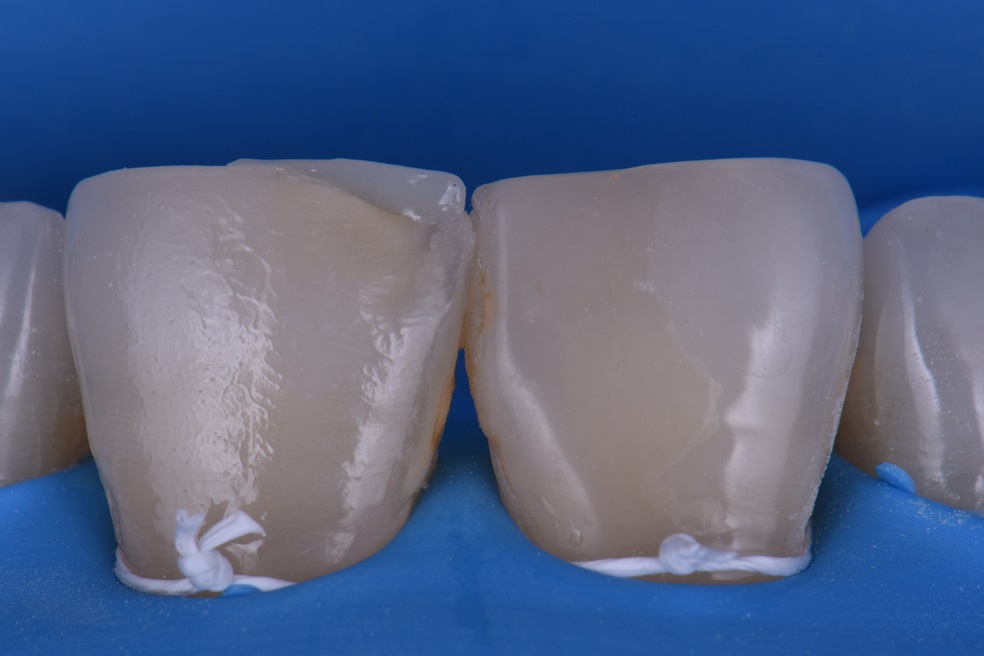 Partial Composite Veneer Auckland