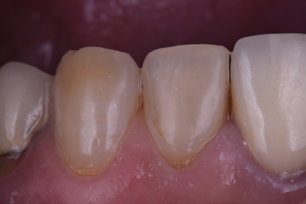 Class V Excellence Dental Abrasion Lesions Class V Excellence Dental ...