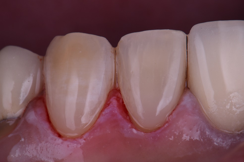 Class V Excellence Dental Abrasion Lesions Class V Excellence Dental ...