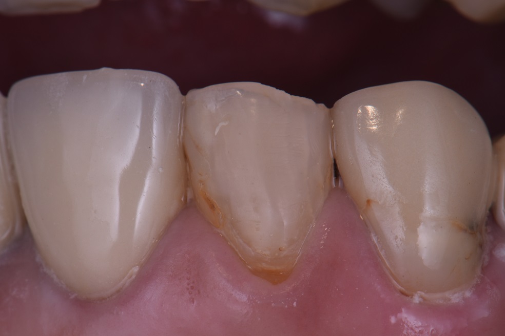 Root Abrasion Restorations Root Abrasion Restorations