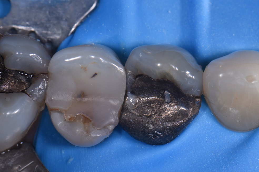 Protecting Root Canal Treated Teeth Protecting Root Canal Treated Teeth