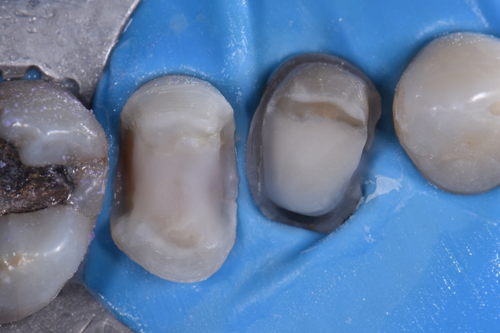 Protecting Root Canal Treated Teeth Protecting Root Canal Treated Teeth